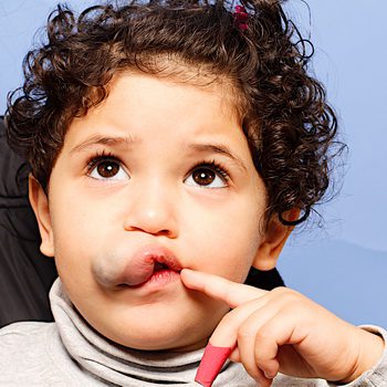 Little Baby Face Foundation | Facial Birth Deformity Corrections